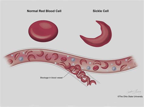 Sickle Cell Disease