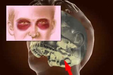 Bruises 5 Things Every Criminal Attorney Should Know Godoy Medical
