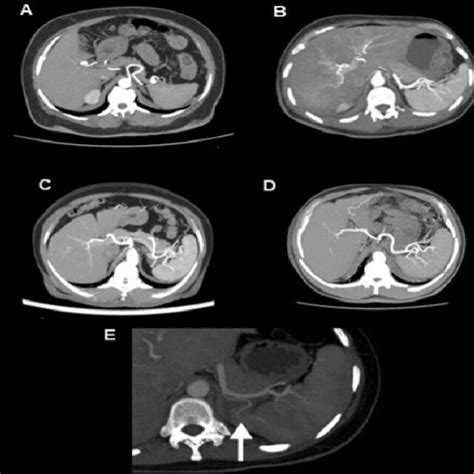 Computed Tomography Sagittal Plane Reconstructions Demonstrating A