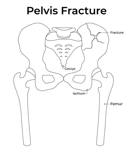 골반 골절 Coccyx Ischium Femur 선형 터 일러스트레이션 흑백 프리미엄 벡터