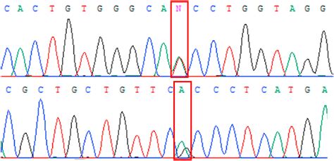 Scn4a Related Congenital Myopathy In A Han Chinese Patient A Case