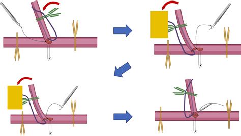Intravascular Flipping Technique For End To Side Microvascular