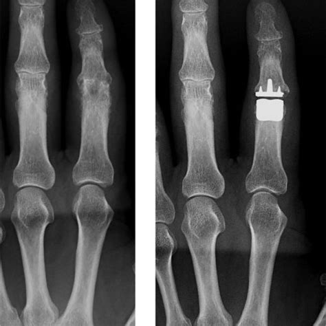 Dorsal Approach To The Pip Joint Either By Central Slip Incision Or Download Scientific
