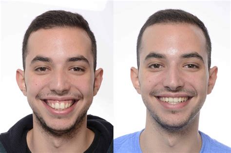 How To Treat Gummy Smiles Using Non Surgical Methods Dentistry