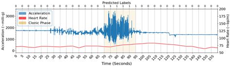1d Convolutional Neural Network Detecting A Tonic Clonic Event A