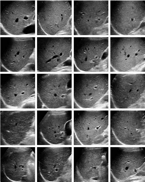 Figure 1 From Automatic Diagnosis Of Significant Liver Fibrosis From Ultrasound B Mode Images