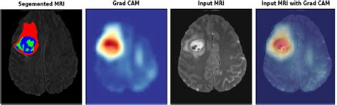 Heatmap Generated At A Particular Depth Of An Mri Download