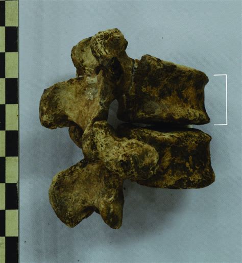 Compression Fracture Of The First Lumbar Vertebra Upper Body In The Download Scientific