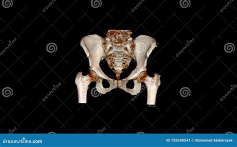 Computed Tomography Volume Rendering Examination Of The Pelvic Bones