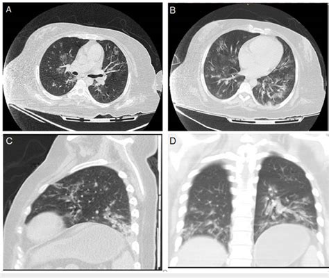 Ct Of The Chest With Multiple Areas Of Increased Density In A Download Scientific Diagram
