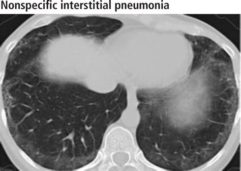 Interstitial Lung Disease Radiology Article At Dwight Dees Blog
