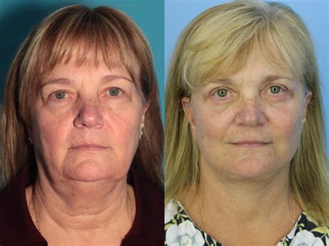 Facelift Before And After Pictures Case 437 West Des Moines And Ames