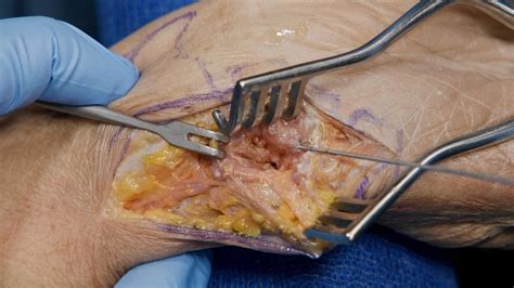 Surgery Scaphoid Fractures