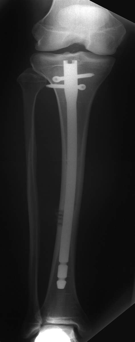 A And B Stress Fracture Of Right Tibia Year Later After Surgery An Download Scientific