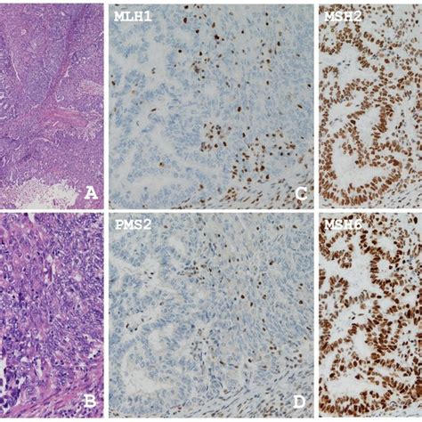 Relation Of Tmb Msi Scores And Mmr Protein Expression A Tmb Scores