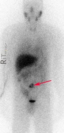 Rit Radiology Extraadrenal Pheochromocytoma I 123 Mibg