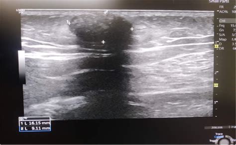 Ultrasonography Showing A Well Defined Oval Hyperechoic Lesion With