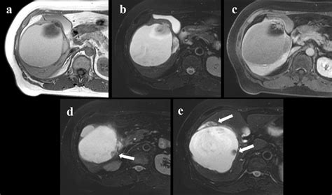 Abdominal Magnetic Resonance Mr Imaging A Axial T1 Weighted Image