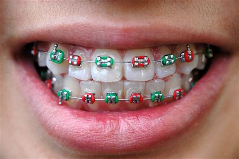 Metal Braces Vs Clear Braces Bali Implant Aesthetic Bia Dental Center