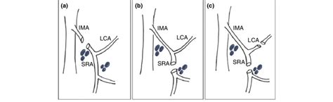 Levels Of Arterial Ligation Extracted From Operative Charts A High Download Scientific