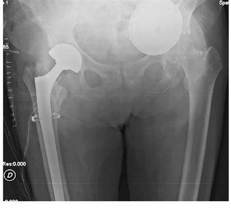 Postoperative Radiograph After Total Hip Arthroplasty Download