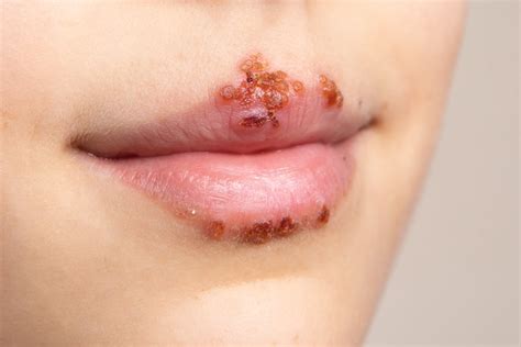 Herpes Photos In Different Stages A Complete Visual Guide
