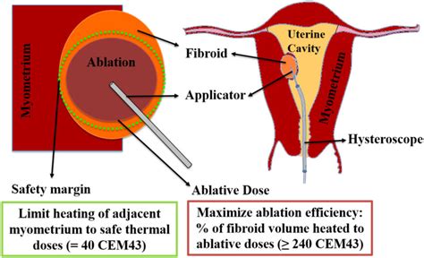 Uterus Anatomy And Treatment Objectives Of Proposed Transcervical