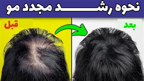نحوه رشد مجدد مو دو دلیل ریزش مو Youtube