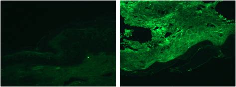 Hydroxychloroquine Induced Hyperpigmentation Of The Skin And Bulls Eye Maculopathy In Rheumatic