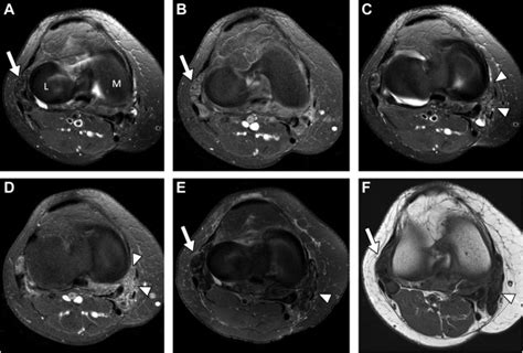 Olecranon Bursitis Mri