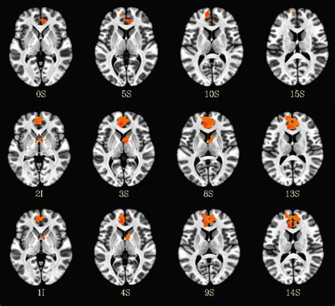 Functional Activation To Monetary Reward Outcome Gain Condition Download Scientific Diagram