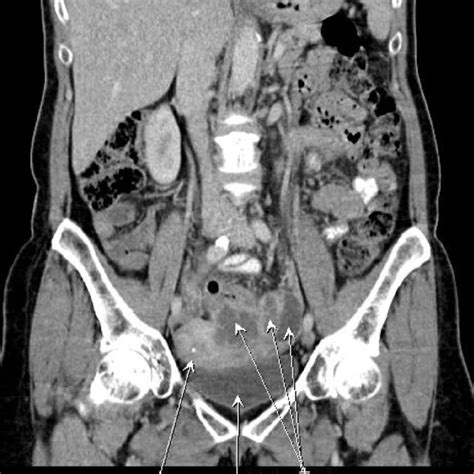 Ct Scan Revealed Solid Cystic Septated And Expansive Lesion In The Download Scientific