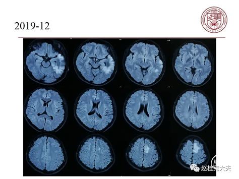 1例rasmussen脑炎患者21个月的随访 脑医汇