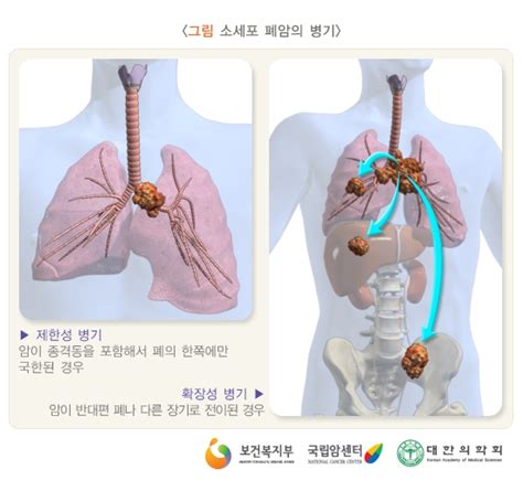 신촌연세병원 호흡기센터 ★ 폐암 그 원인과 증상 치료법 네이버 블로그