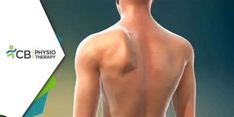 Winged Scapula The Vital Role Of Physiotherapy In Effective