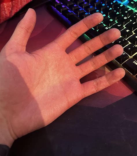 White Fingers And Hyperhidrosis R Hyperhidrosis