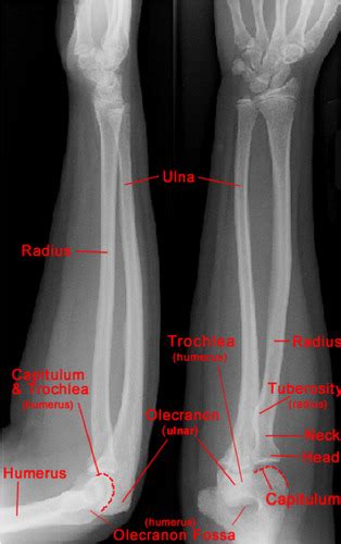 E Ortho Elbow Forearm Flashcards Quizlet