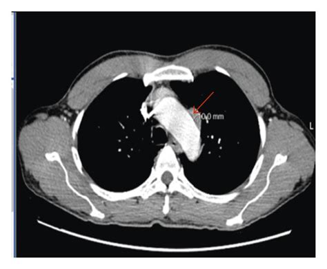 Ac Ct Imaging Of The Chest Without Contrast Illustrates Are New