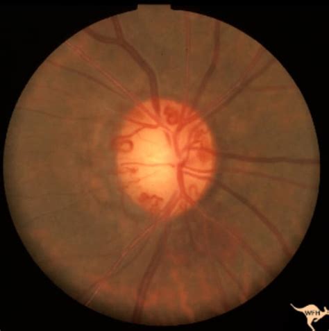 Nettleship Collaterals Ophthalmology Notes And Synopses Facebook