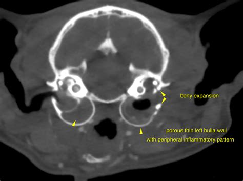 Ct Severe Chronic Otitis Media And Externa With Bulla Wall Lysis And
