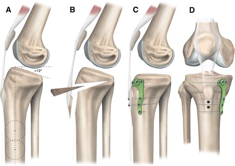 Acl Tear Dr Jesper Fritz