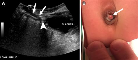 Imaging Of The Urachusradiographics