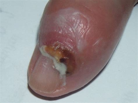 Calcinosis Knuckles