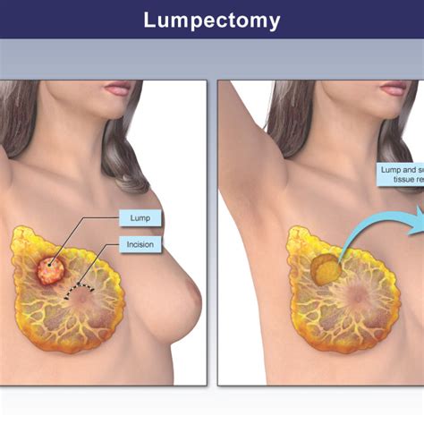 Lumpectomy Trialquest Inc