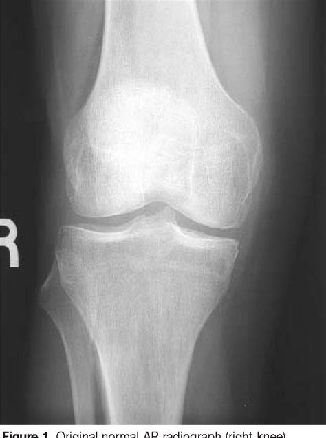Figure 1 From Kissing Cartilage Lesions Of The Knee Caused By A