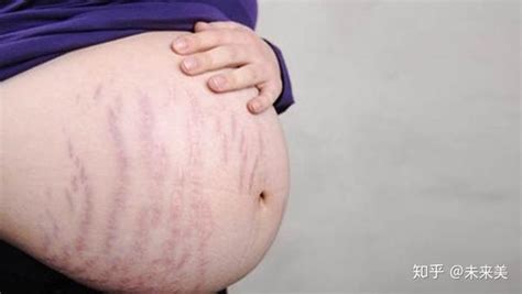 妊娠纹的形成原理？一个气球让你深入了解妊娠纹 知乎