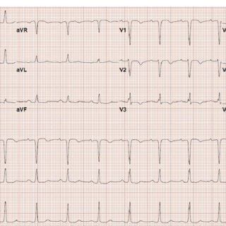 ECG Obtained On Day 2 Showing Resumption Of Left Bundle Branch Block Download Scientific