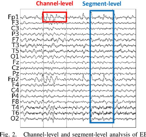 Transformer Convolutional Neural Networks For Automated Artifact Detection In Scalp Eeg