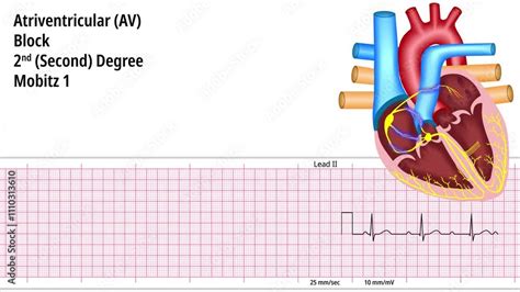 Second Degree Atrioventricular Block Mobitz 1 2nd Degree Av Block Mobitz 1 Ecg And Heart