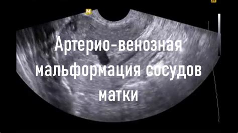 Артерио венозная мальформация сосудов матки Youtube